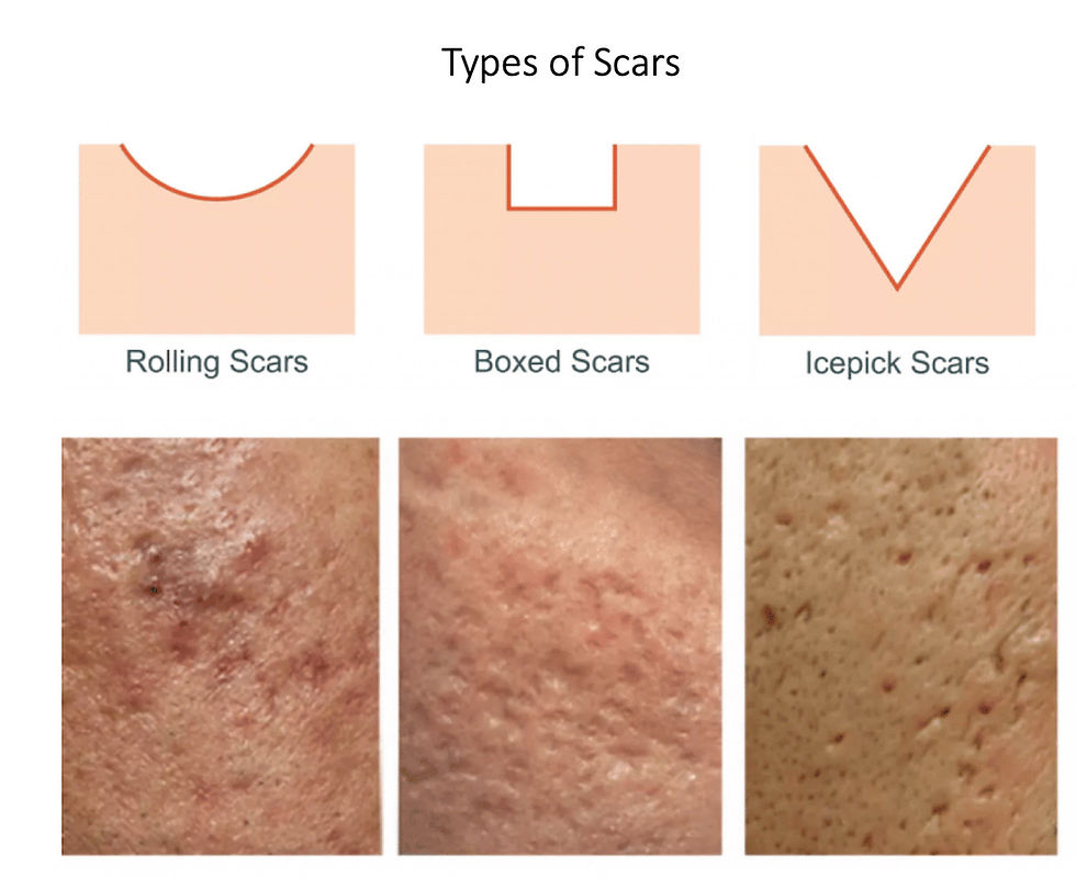 Scar & Uneven Skin Texture