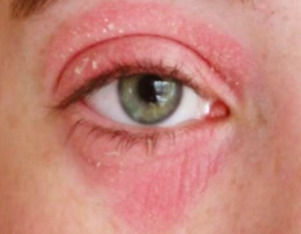 Allergies and your Eyes