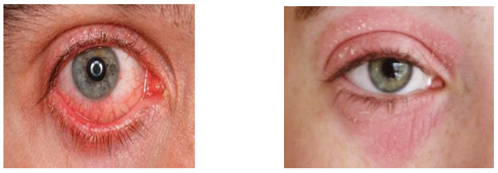 Allergies and your Eyes