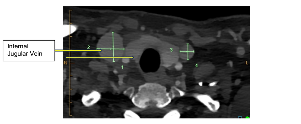 Internal Jugular Vein Dysfunction- Jugular Outlet Syndrome, Internal ...
