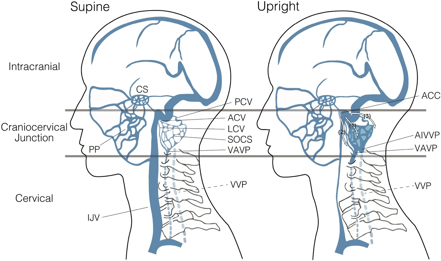 Internal Jugular Vein Dysfunction- Jugular Outlet Syndrome, Internal ...