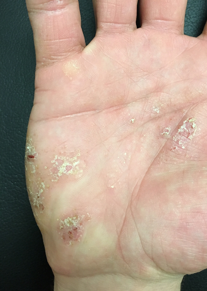 Allergic Skin Reactions on the Job: Occupational Allergic Contact ...