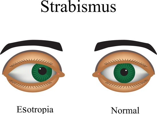 Lazy Eye The Different Types With Common Symptoms lazy-eye-the-different-types-with-common-symptoms