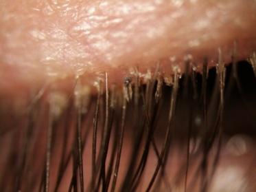 What is Blepharitis? Signs and Symptoms