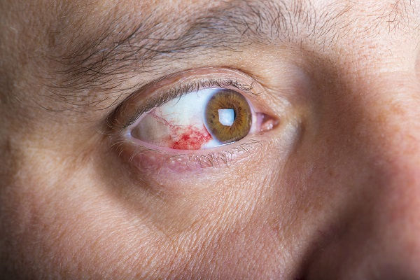 There Is A Red Spot On My Eye Red Spot In Corner Of Eye there-is-a-red-spot-on-my-eye-red-spot-in-corner-of-eye