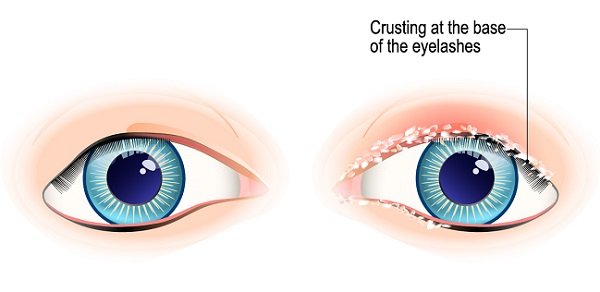 3 main reasons you have particles in your eyelashes