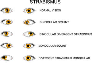 My eyes appear to be crossed (cross eyed)