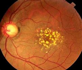 Focus On: Macular Degeneration