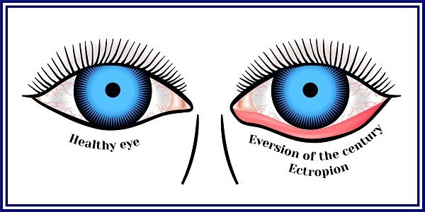 My eyelid is turning inwards - potential reasons