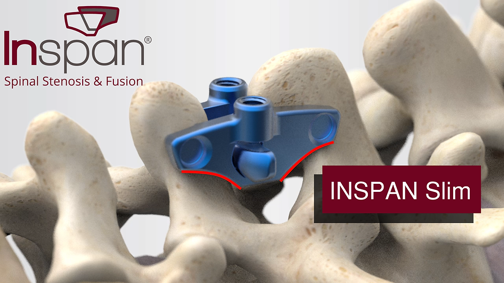 Inspan Is The First Interlaminar Spinous Process Fixation Device FDA ...