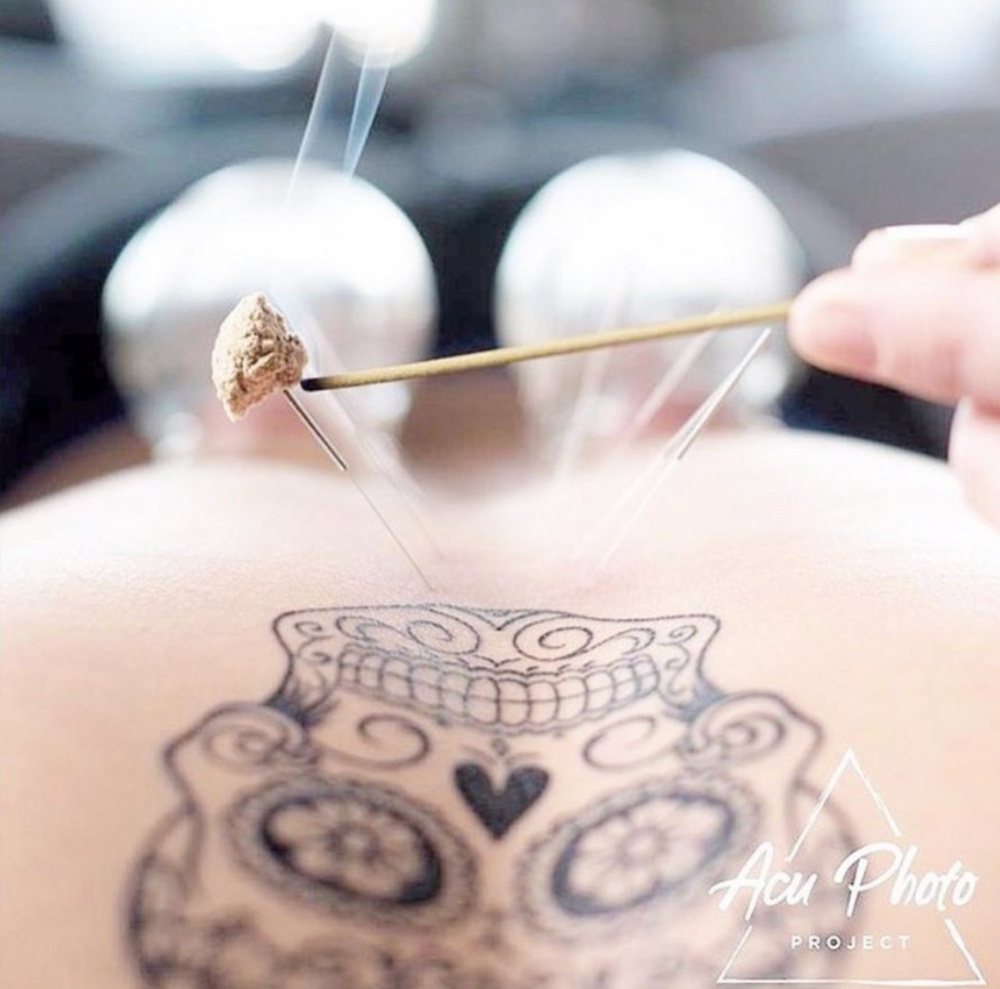 Fire Cupping vs. Hand Pump Cupping