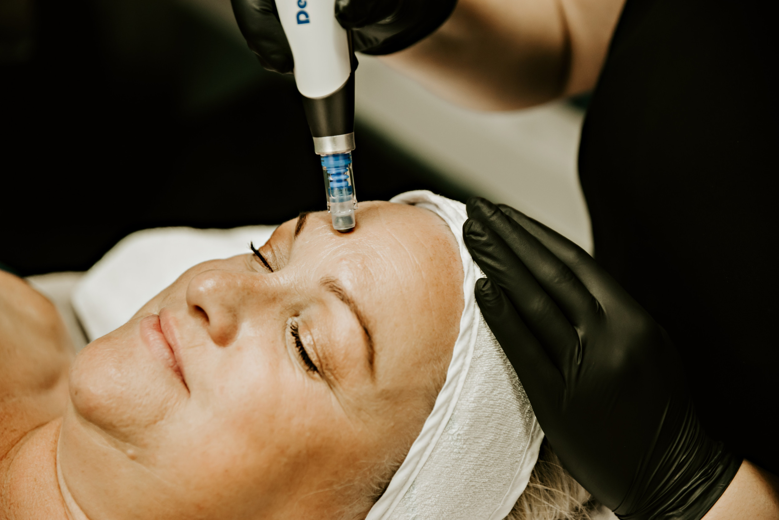 Microneedling | Dermapen Skin Rejuvenation at Massage Me & Beautify You