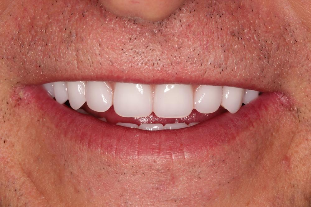 My teeth are wobbly