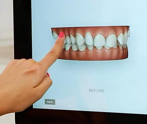 Aparat dentar Invisalign (Invizibil / Transparent) - Pret & Tratament ...