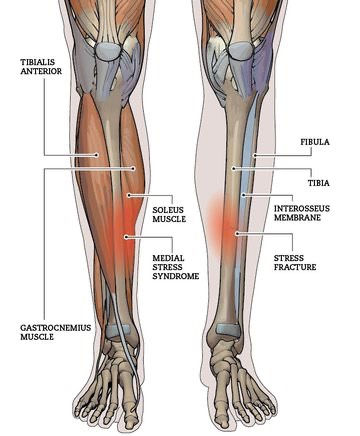Medial Tibial Stress Syndrome/Chronic Exertional Compartment Syndrome