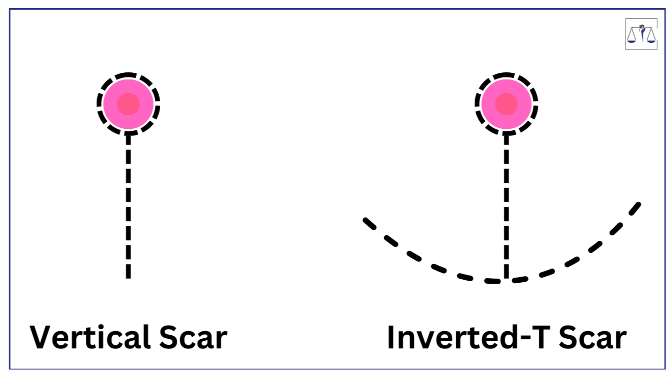 Breast Surgery - What Scar Will I Have?