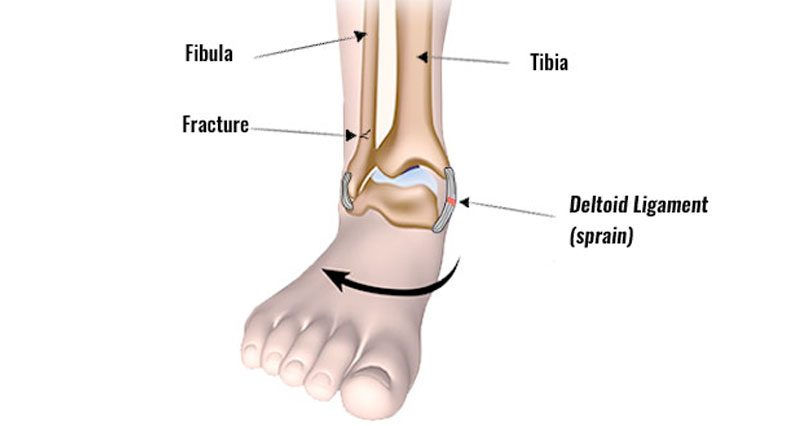 7 Types Of Football Ankle Injuries