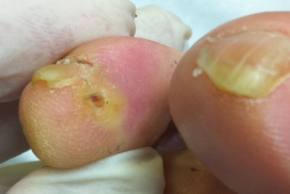 Understanding Different Types of Corns on Your Feet