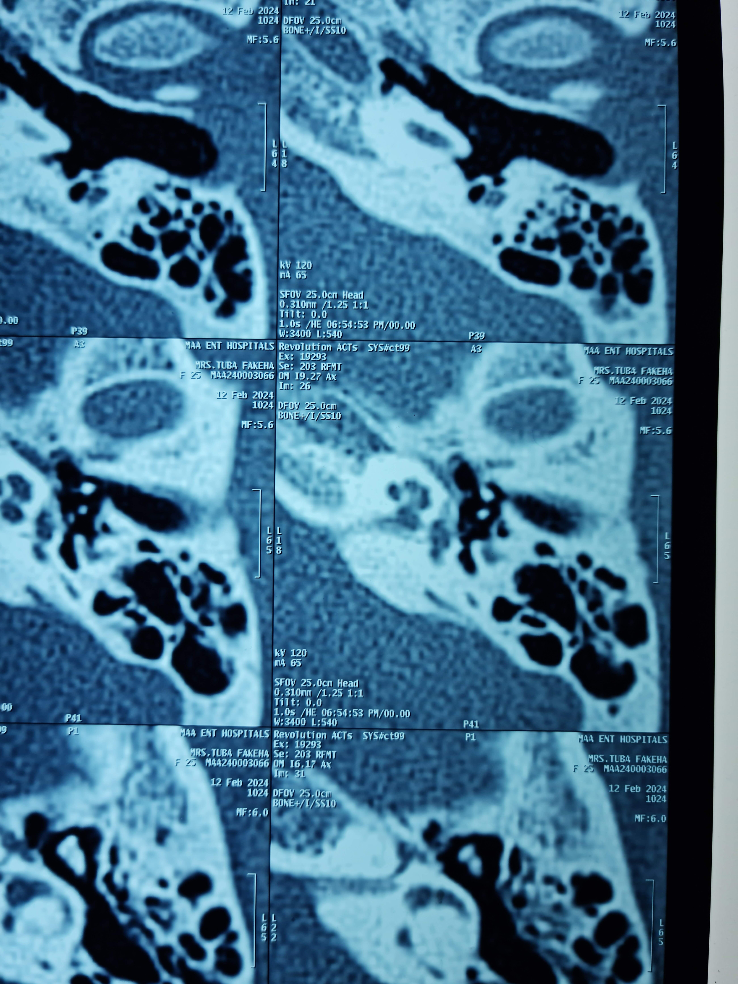 Otosclerosis and Otospongiosis – Inner Ear bone disease