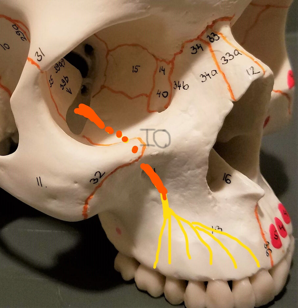 INFRAORBITAL INJECTION