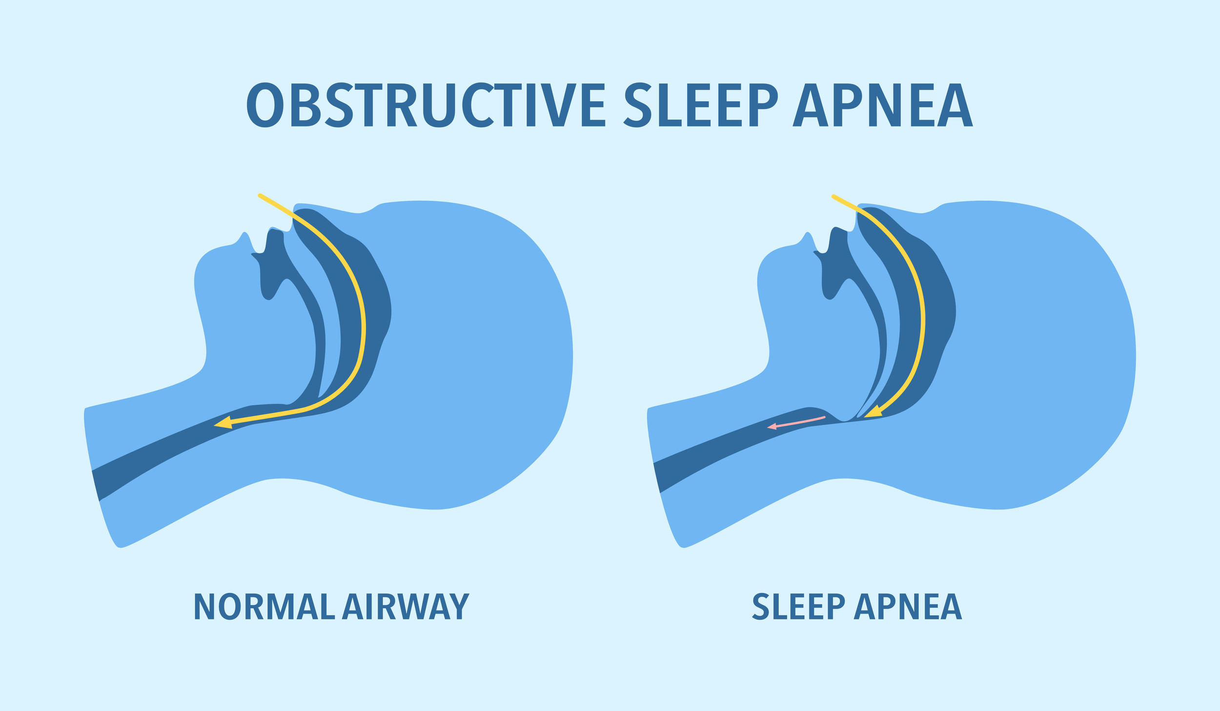 5 Signs of Sleep Apnea & Inspire Therapy | Topeka ENT
