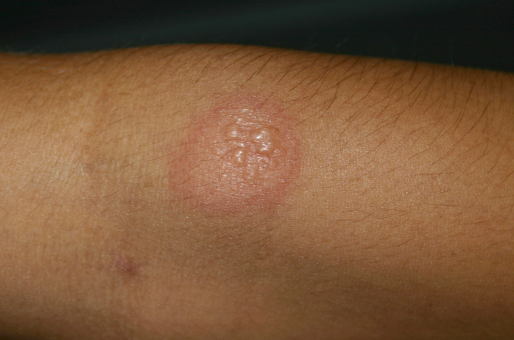 Tuberculosis cutánea