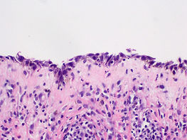 Pénfigo vulgar | Clínica Arthur Nouel