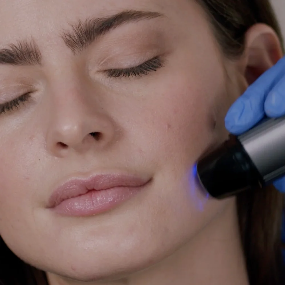 Needle-Free Services That Win: 3 Pro Devices Providing Microneedling ...