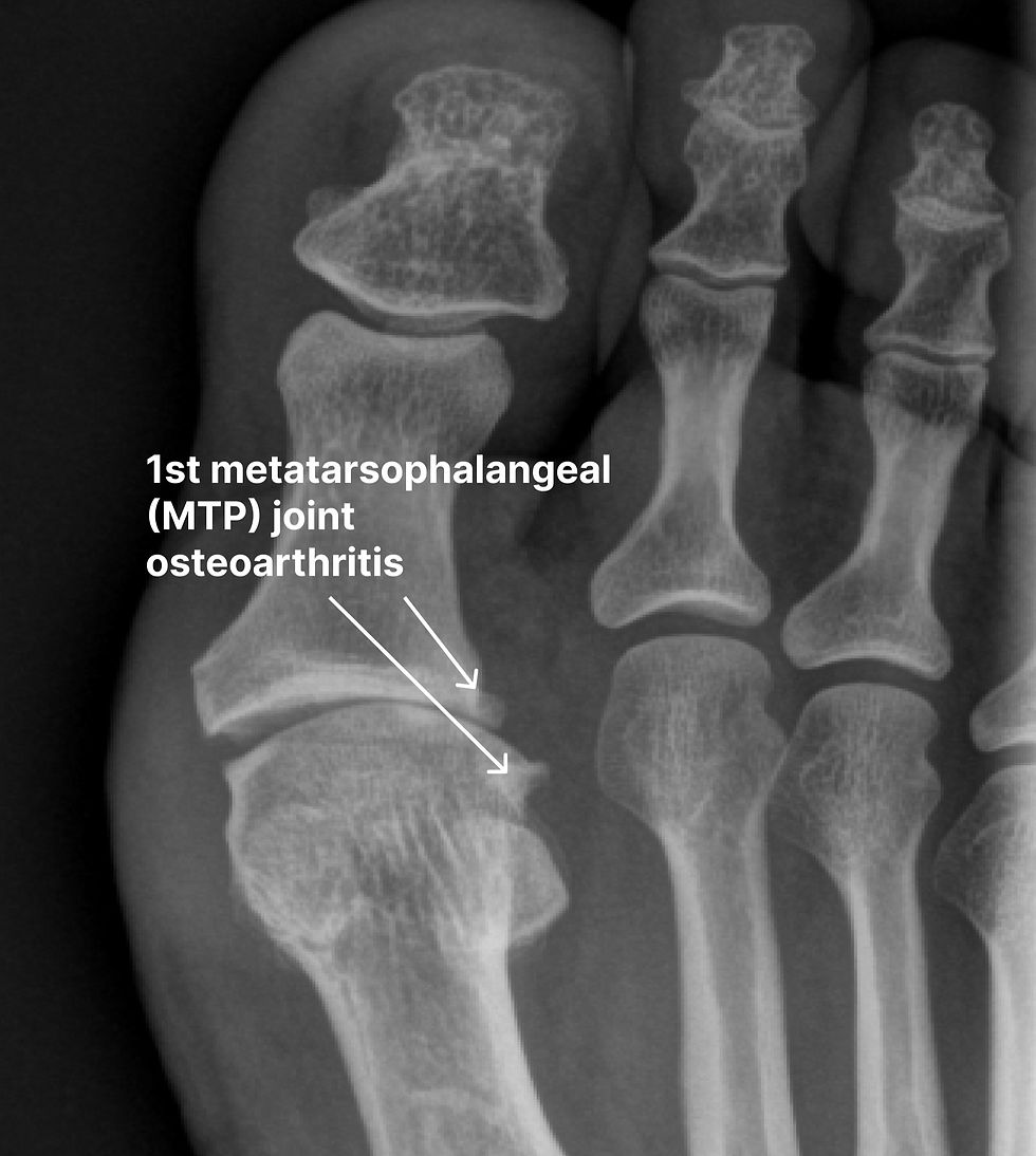 The Big Toe Joint Keeps you Moving Forward | Find Your Stride ...