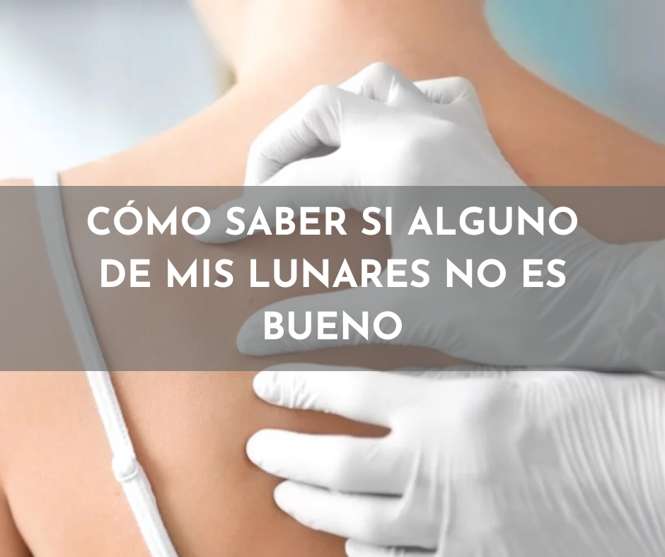 Cómo saber si alguno de mis lunares no es bueno