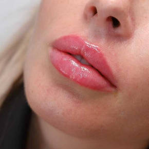 Honey Lips | cosmetic injections | 114 New Cavendish Street, London, UK