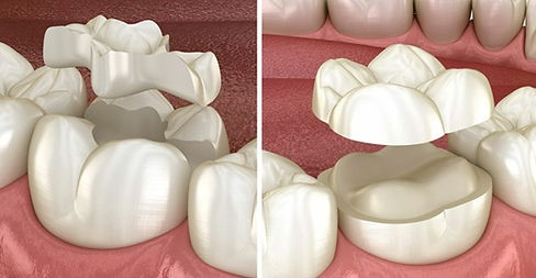Dental Crowns & Onlays | Parnelldentistry