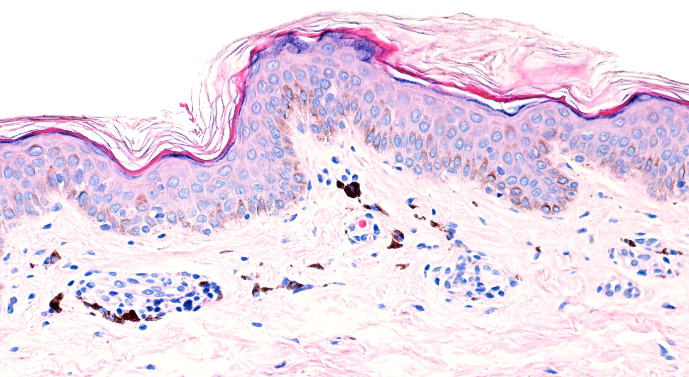 2017 Enero a Junio | dermatopatologia-ces