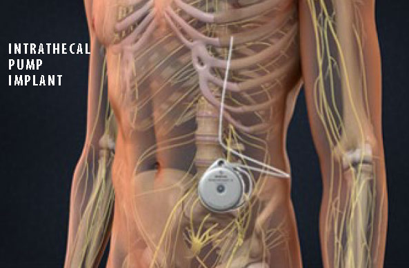 Pain physician near Nashville | Tennessee | Nashville Pain Center