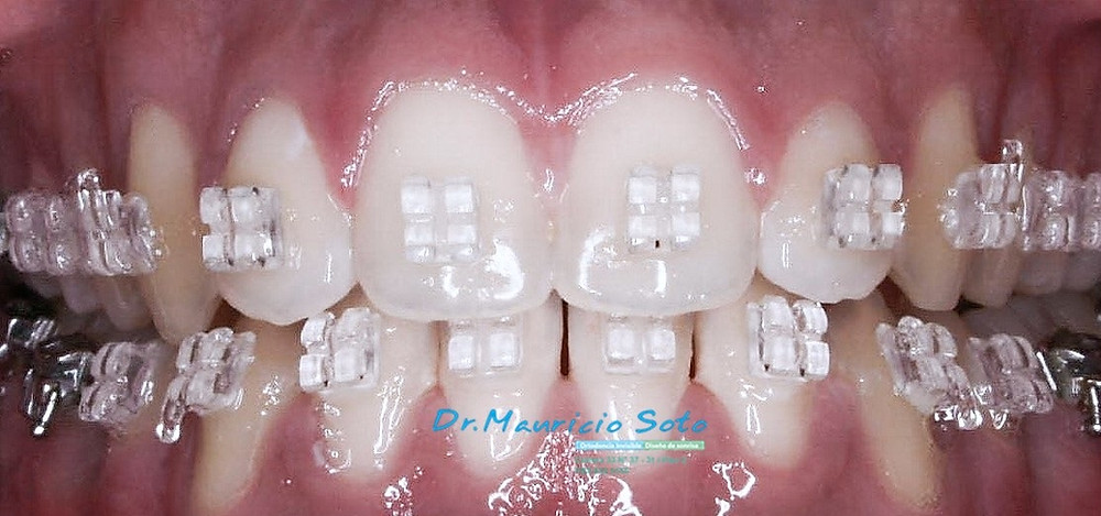 Brackets Transparentes