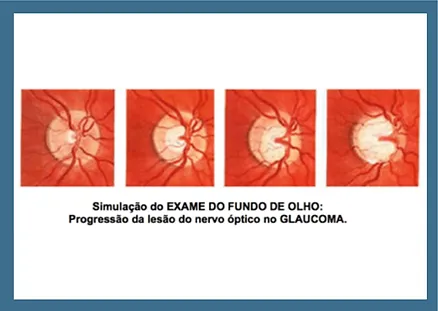 Dra. Bruna Vilella - Oftalmologista em Ribeirão Preto | Glaucoma