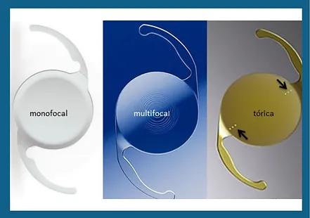 Cirurgia de Catarata em Ribeirão Preto | Dra. Bruna Vilella