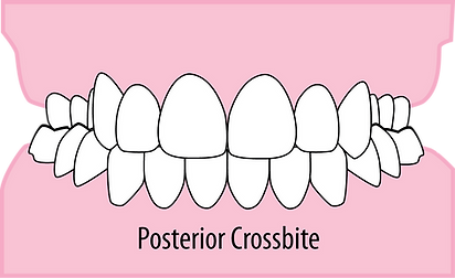 Overbite, Underbite and Crossbite | Orthodontic Conditions
