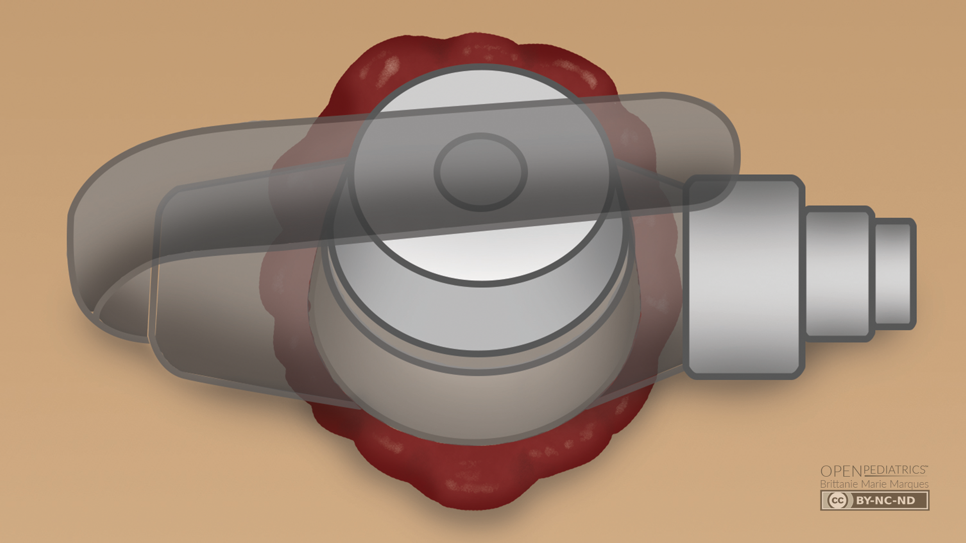 Gastrostomy tube with granulation tissue