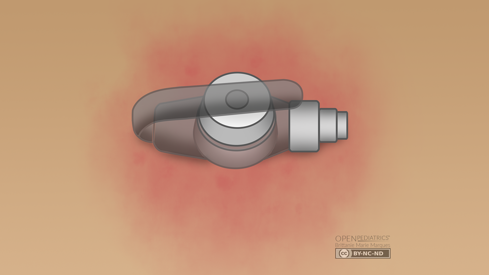 Gastrostomy tube site dermatitis