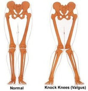 Dynamic Knee Valgus