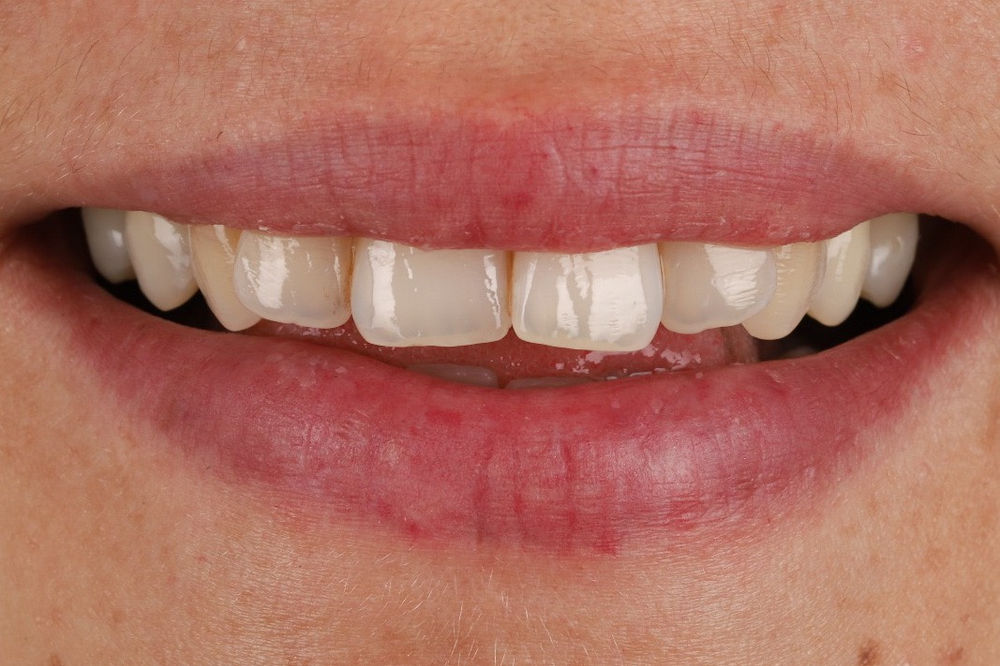 Behind the smiles: preventing dental problems with regular dental and ...