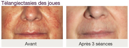 Lésions Vasculaires- Dr Frey - Médecine Esthétique & Laser ...