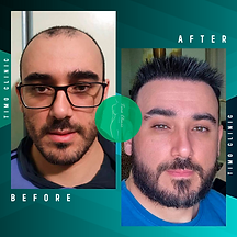 Hair Transplant | Timo Clinic Turkey
