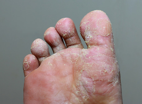 Dermatology Foot Conditions we treat at Foot and Ankle Center of West ...