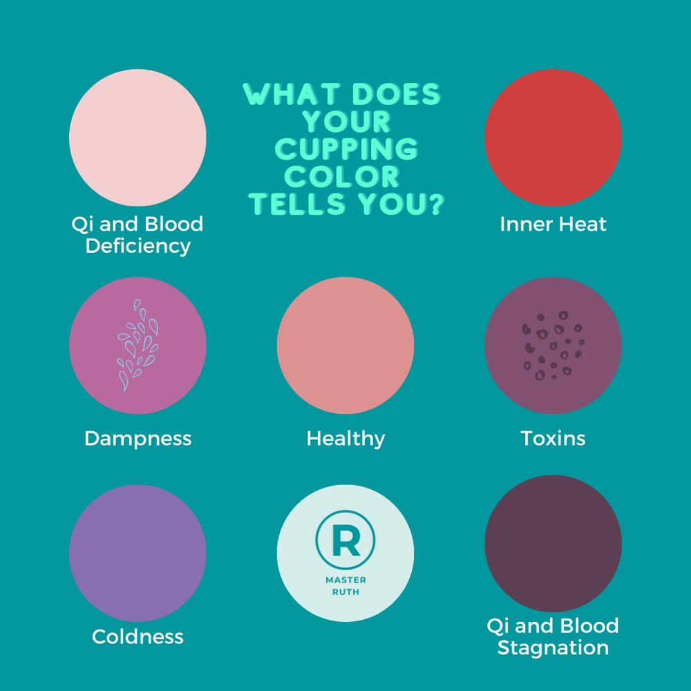 How does cupping therapy help for detoxification?