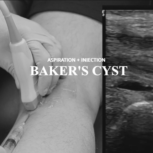 Bakers Cyst Diagnosis & Aspiration | MUST: Msk Ultrasound