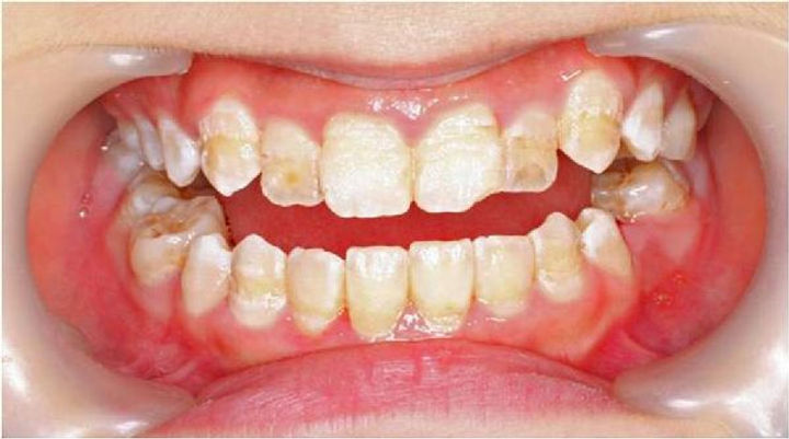 Enamel hypoplasia: what is it and how to treat it?