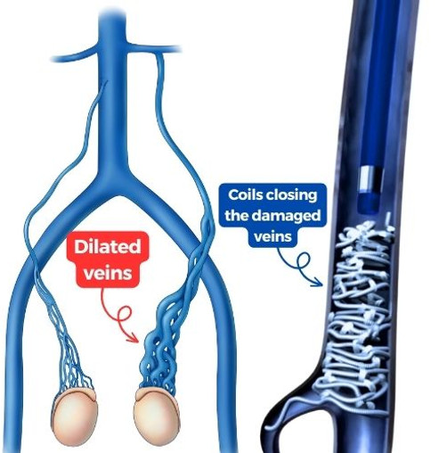 Varicocele Embolization | No surgery | DrNagateja