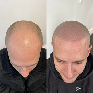 Scalp Micropigmentation | Treatment & Training | INKD SMP